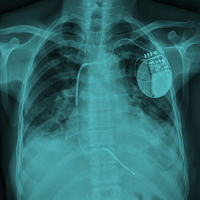 Medical-Heart Pumping Strength